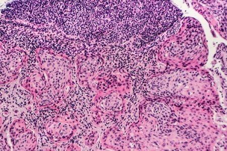 Castleman’s Disease: Types, Symptoms, Diagnosis - DiseaseFix