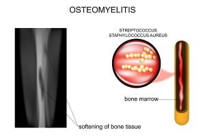 Osteomyelitis (Bone Infection) Symptoms & Diagnosis - DiseaseFix
