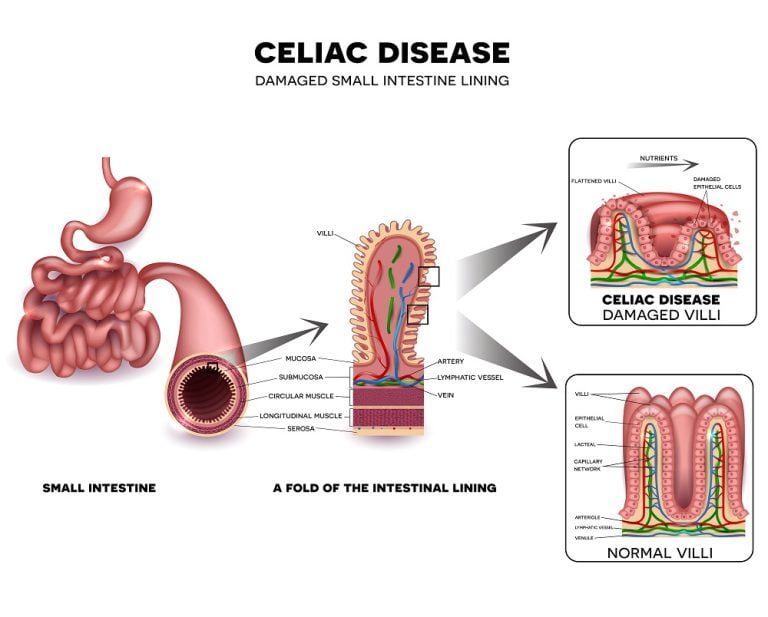 Symptoms of Celiac Disease in Children & Adults - DiseaseFix