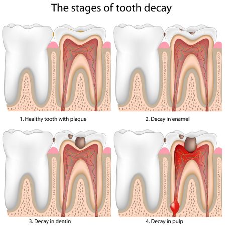 Dental Caries (Cavity): Tooth Decay Formation, Stages & Risks - DiseaseFix
