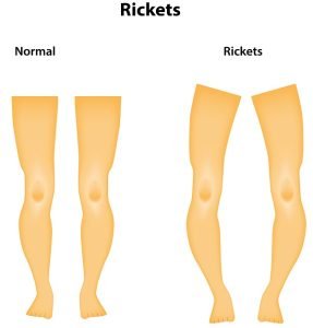 Rickets Symptoms, Causes & Prevention - DiseaseFix