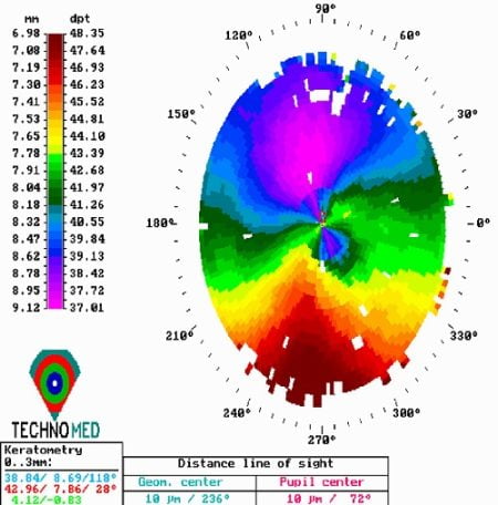 Corneal Topography Mapping – Procedure & Techniques – DiseaseFix