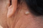 Lumps Behind the Ears: Causes. Symptoms. Diagnosis.