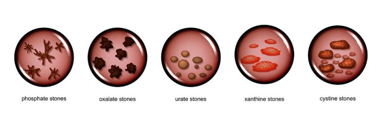 Kidney Stone Size Chart in CM & MM - Diseasefix