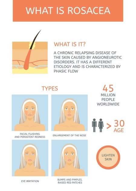 Rosacea Types, Symptoms & Treatment - DiseaseFix