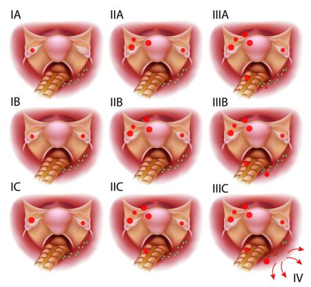 Welcome to DiseaseFix Section for Osteomyelitis (Bone Infection) Condition