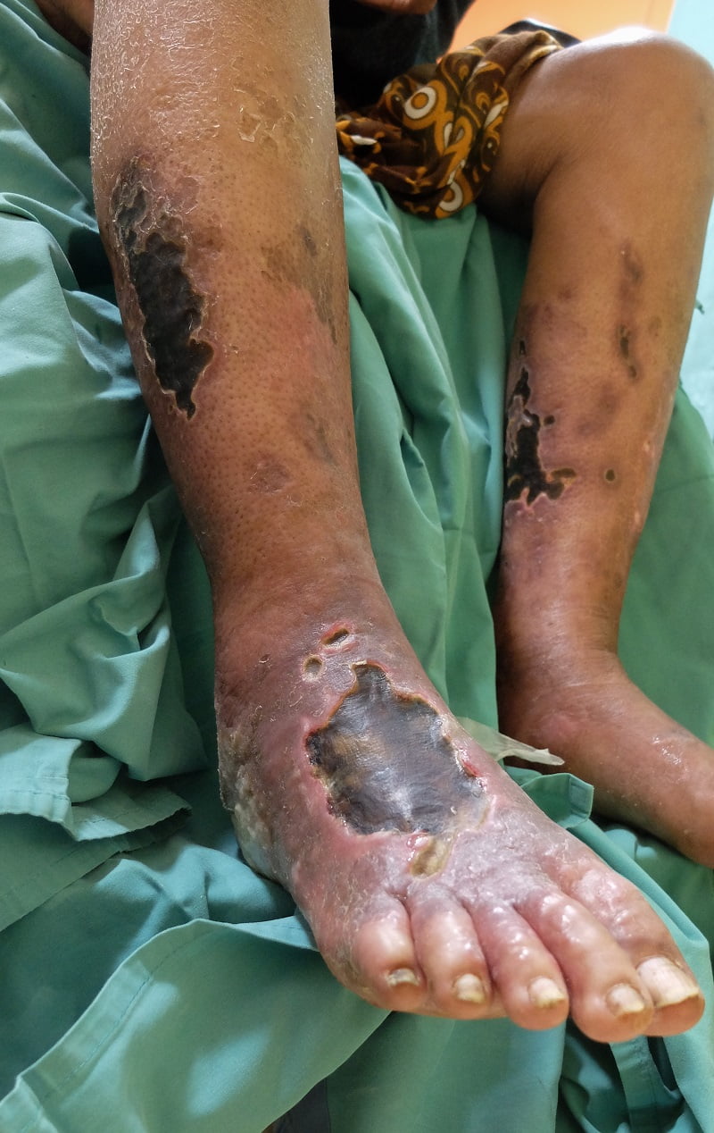 Diabetic foot ulcer with chronic limb ischemia - Disease, Health ...