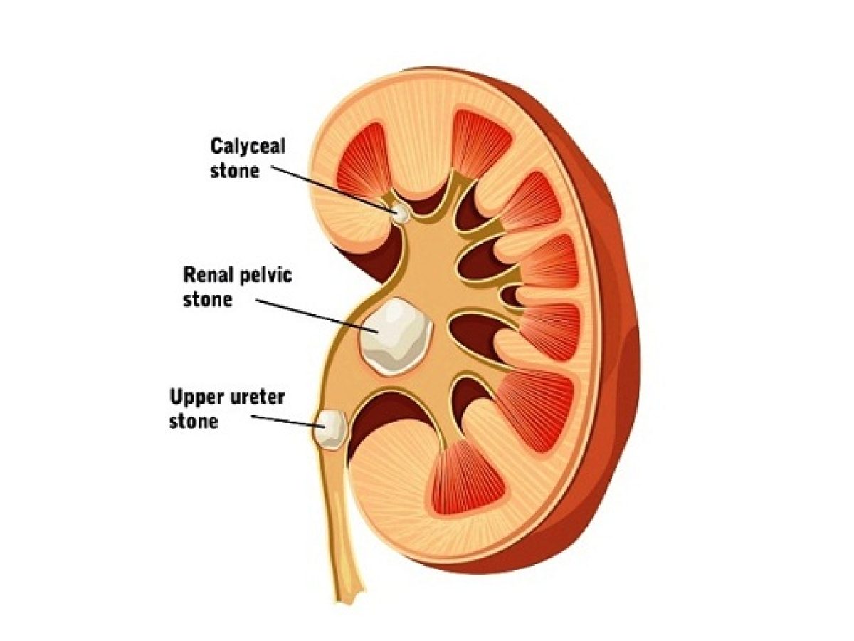 Types Of Kidney Stones By Color