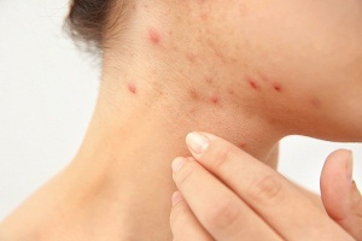 Scabies Rash On Face