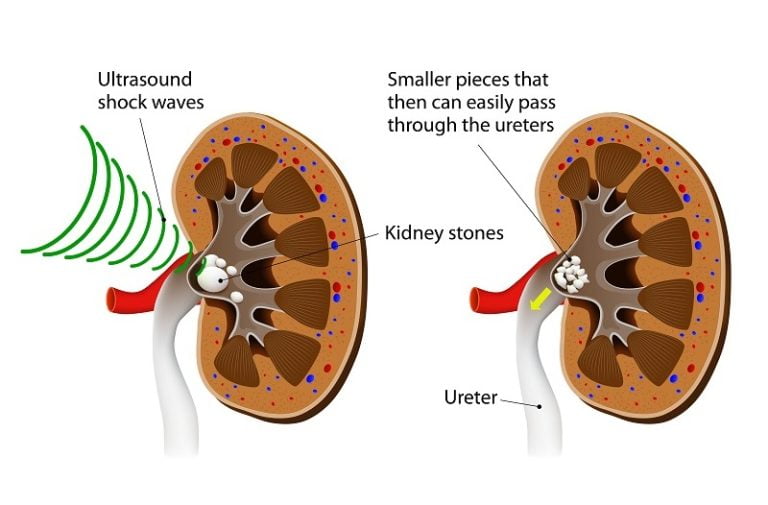 Kidney Stone Size Chart in CM & MM - Diseasefix